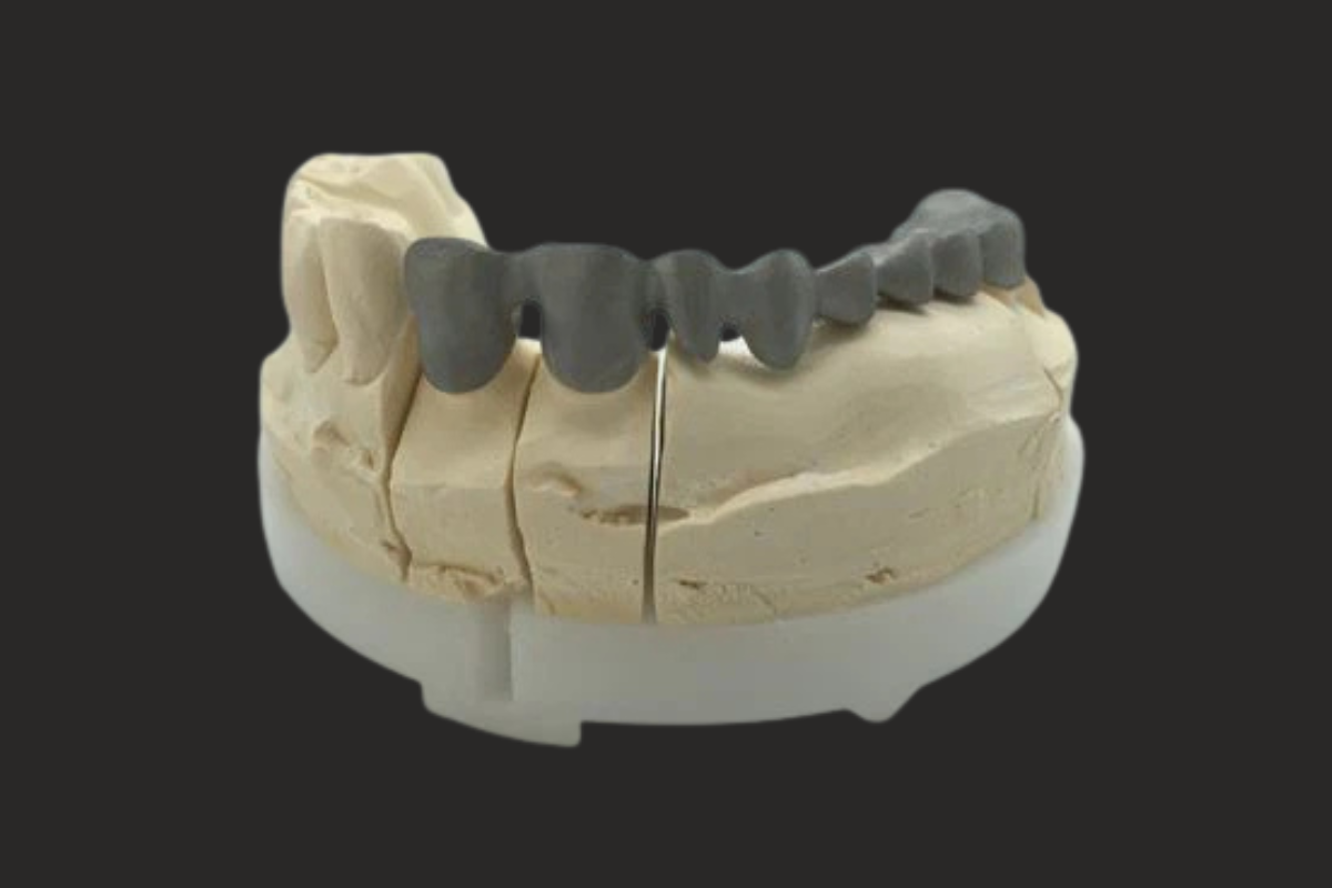 Durable and Aesthetic PFM Crowns for Healthy Smiles