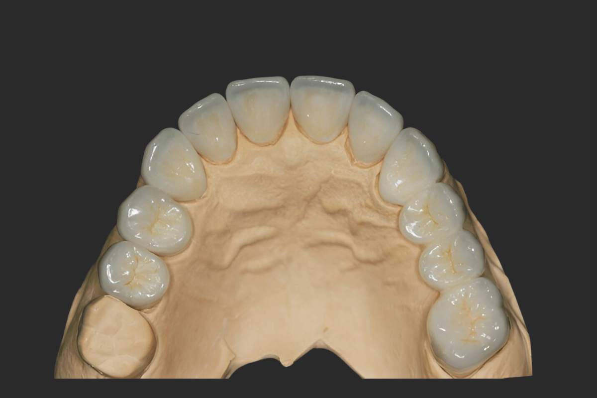 Zirconia Crowns and Bridges: A Durable Dental Option
