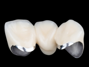 Dental Crown and Bridge Service for Better Teeth