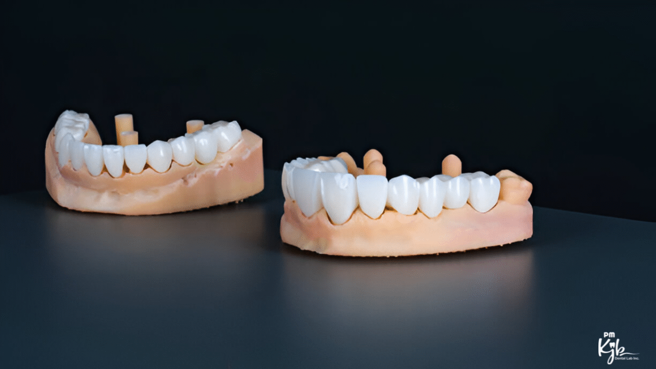 PFM vs. Zirconia Crowns: What Dentists Need to Consider