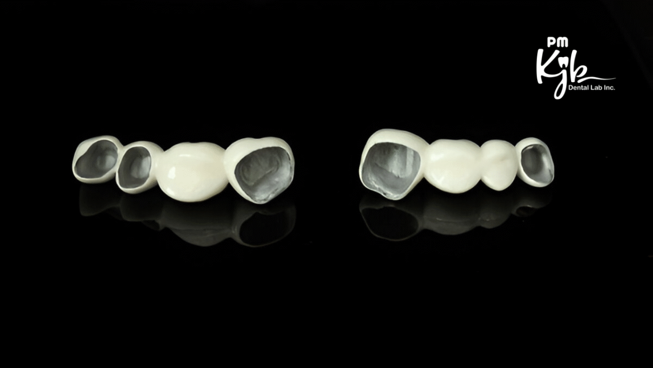 The Complete Guide to PFM Bridges in Dental Restorations