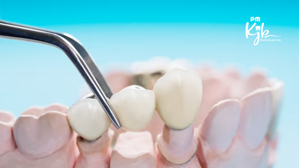Modern Dentistry and PFM Bridges: Are They Still Worth It