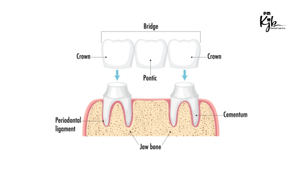 Improve Your Smile with Crown and Bridge Treatment